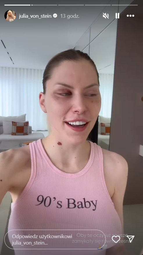 Julia von Stein dwa tygodnie po liftingu twarzy | Papilot
